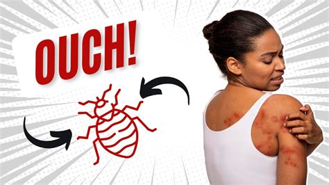 What Does Bed Bug Bites Look Like On Black Skin At Alice Hager Blog