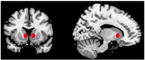 Nucleus Accumbens Seed Bilateral Nucleus Accumbens Seed Used In
