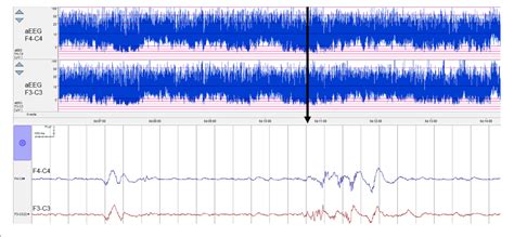 Figure 1 From Quantitative Preterm Eeg Analysis The Need For Caution In Using Modern Data