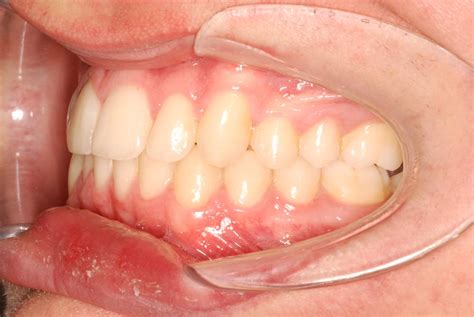 Orthodontic Treatment Without Extractions Ορθοδοντικός στην Κέρκυρα