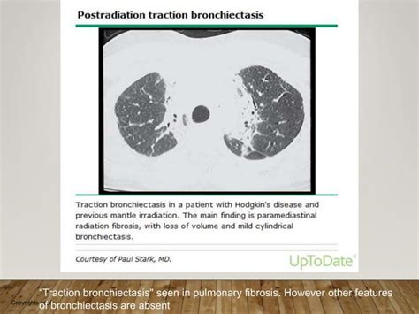 Bronchiectasis Ppt