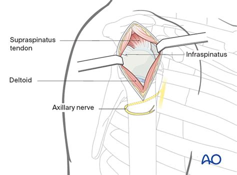 Lateral Approach With Deltoid Splitting