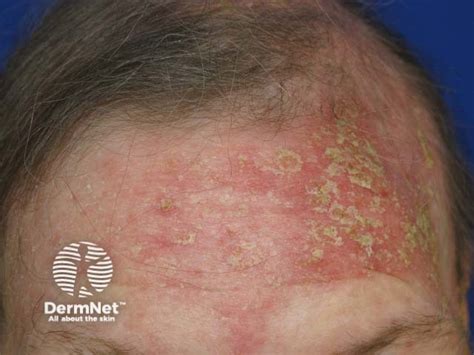 Dermnet Psoriasis Psoriasis Symptoms Treatment Images And More