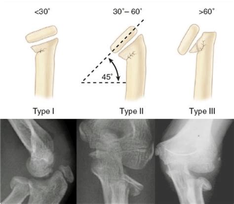 Radial Head Fracture Classification