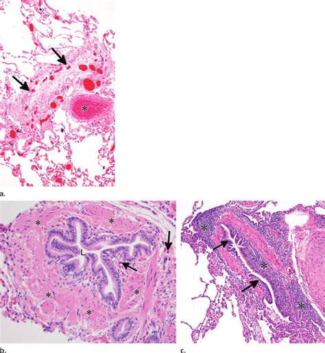 Causes Of Small Airway Obstruction What Causes Airway Obstruction