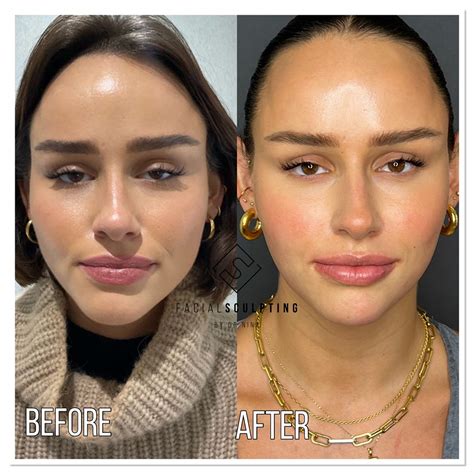 What To Expect In Cheek Filler Treatments For Asymmetry Doctor Lanna