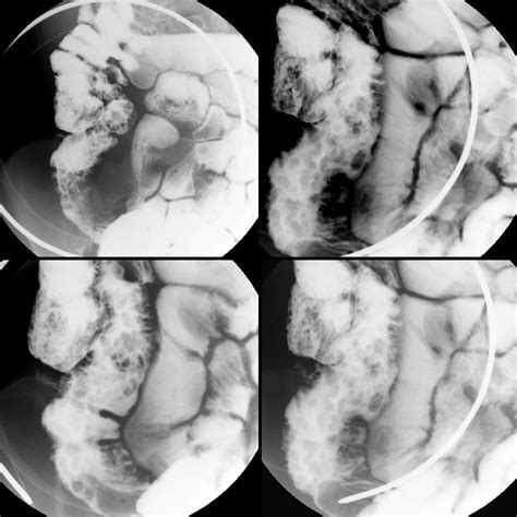 Intestinal Nodular Lymphoid Hyperplasia