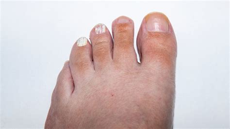 Benefits Of White Superficial Onychomycosis Treatment Indiana Adoptee