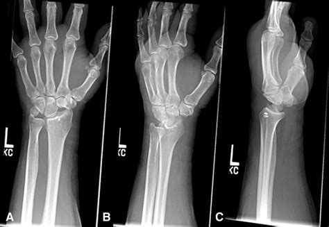 Complete Anterior Scaphoid Expulsion In Transscaphoid Lunate