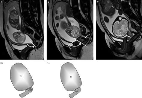 Arabin Cervical Pessary In Women At High Risk Of Preterm Birth A