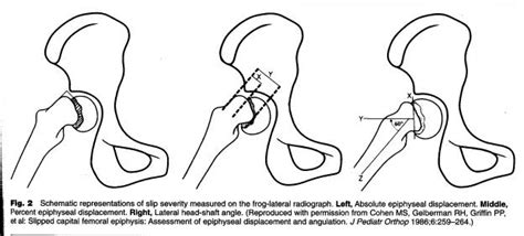Slipped Capital Femoral Epiphysis Scfe Team Bone