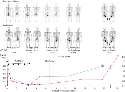 Prediction Of Survival Benefit Using An Automated Bone Scan Index In Patients With Castration