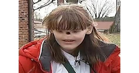 Американска девойка живее без очи и нос