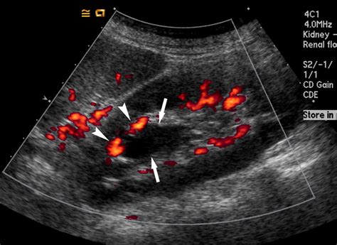 Renal Papillary Necrosis Review And Comparison Of Findings At Multi