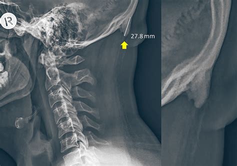 Lump Above Occipital Bone