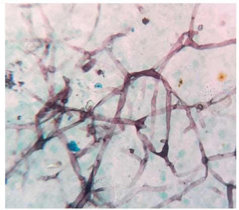 Aspergillus Biopsy Bsvp Histo Slide Club September 2017