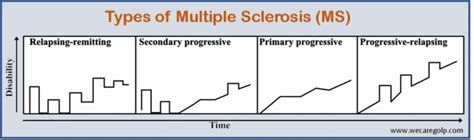 Beyond The Stroke A Case Report Of Multiple Sclerosis Pmc