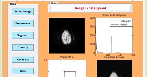 Rough Set Theory Based Brain Tumor Detection On Dicom Images Matlab Project With Source Code