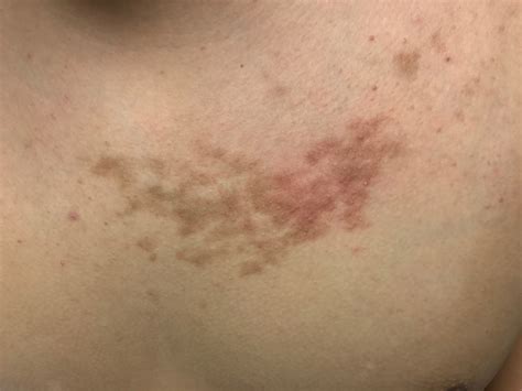 Spina Bifida Occulta Hair Patch