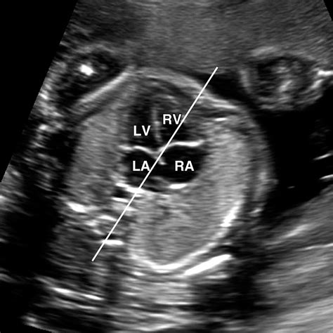 Fetal Cardiac Us Techniques And Normal Anatomy Correlated With Adult Ct And Mr Imagingradiographics