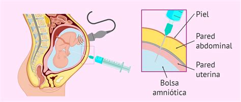 La Amniocentesis ¿cuáles Son Sus Indicaciones Y Posibles Riesgos