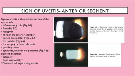 Slide Uveitis Anterior To Posterior Pptx Eye And Vision Conditions