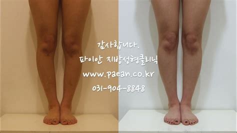 휜 다리 오다리 X다리 안예쁜 다리는 휜 다리 지방이식으로 고민 해결 Youtube