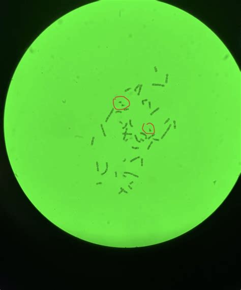 Trisomy 21 Rmedlabprofessionals