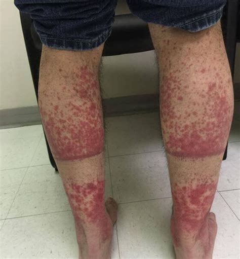 Understanding Henoch Schonlein Purpura Iga Vasculitis Causes