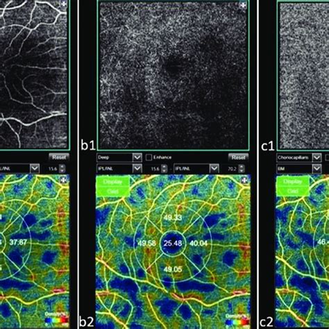 A 6 6 Mm 2 Area OCT A Image A1 And Density A2 In The Superficial Download Scientific
