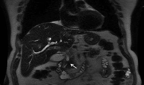 Acg Case Reports Journal