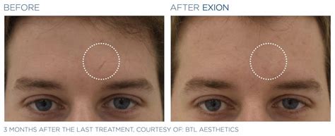 Pimple Scar Reduction Pulse Body Rejuvenation Adelaide