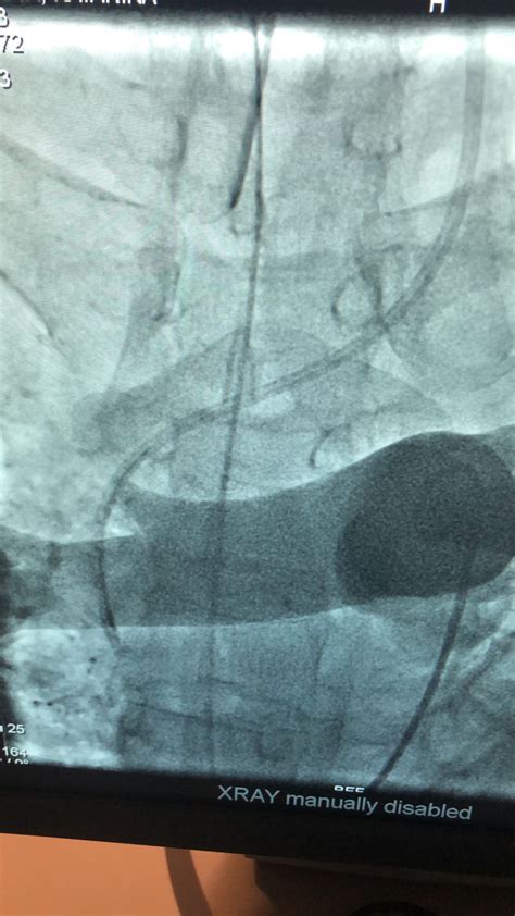 Percutaneous Pulmonar Embolectomy In Ecmo Patient Daniel Todaro