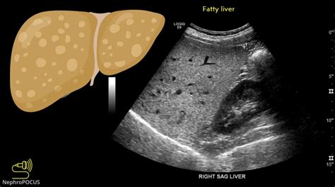 Liver Parenchyma Understanding The Vital Organ