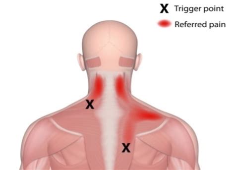 Trigger points Ένας υποχθόνιος πόνος που δεν εξαφανίζεται OffLine Post