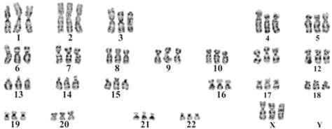 Triploid Syndrome Wikipedia