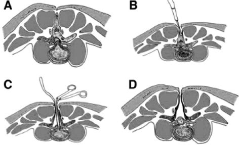 A Split In Spinous Process