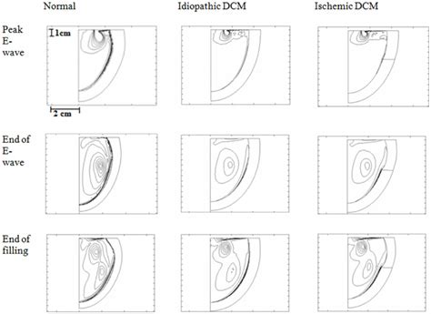 Instantaneous Vorticity Contour Plot In Normal Lv Idiopathic Dcm