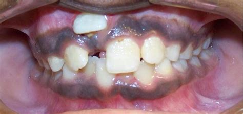 Ectopic Eruption Premiere Orthodontics