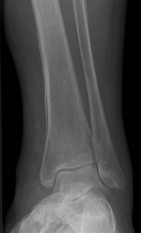 Periosteal Reaction And Types Of Periosteal Reaction