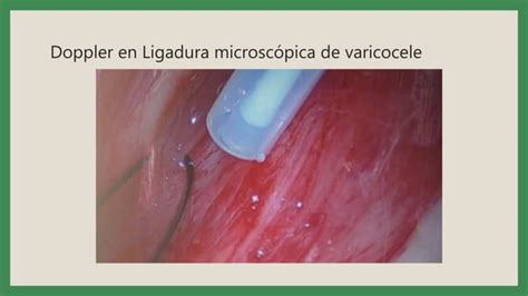 Varicocelectomia Subinguinal Microquirurgica Pptx