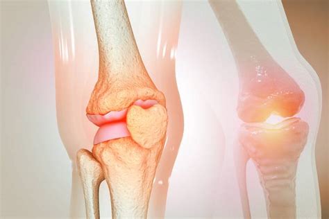 뼈마디 뻣뻣 ‘류마티스관절염2년내 치료가 ‘관건