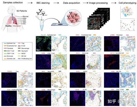 Cancer Cell｜空间单细胞蛋白组发现肺腺癌前驱病变免疫逃逸关键靶点tim 3 知乎