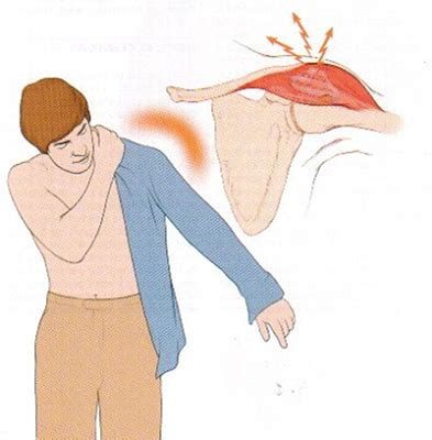 Pinzamiento subacromial Dr Homero Pérez García