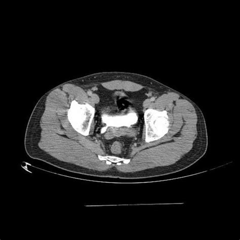 Pin On Urogenital Radiology