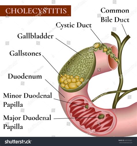 Cholecystitis Inflammation Gallbladder Bile Ducts Gallstones 库存矢量图（免版税）420103321 Shutterstock