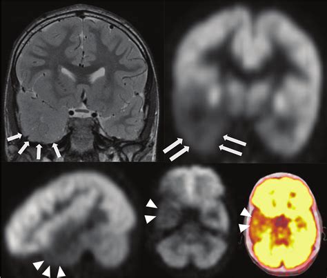 Brain Mri In Patient With Focal Cortical Dysplasia Visualized As Download Scientific Diagram