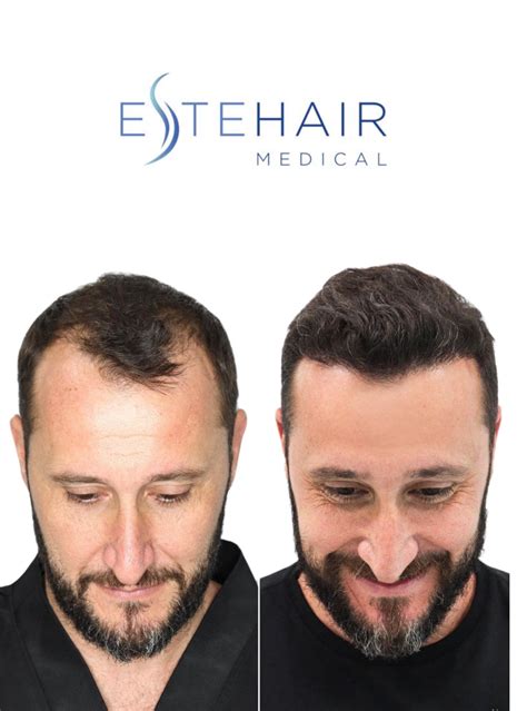 Exosome Hair Loss Treatment Este Hair Medical