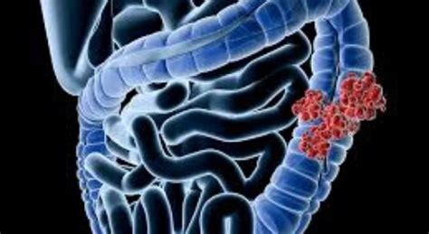 Appendix Cancer Treatment