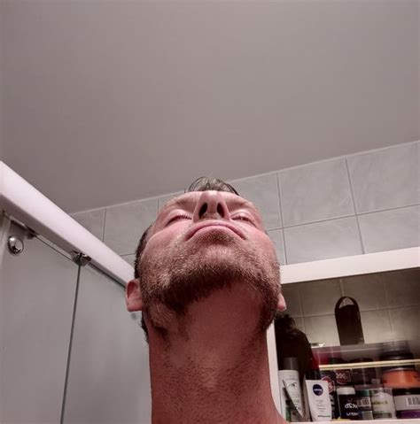 One Month Of Olumiant R Alopecia Areata